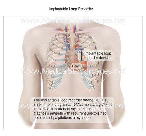 Image result for Loop Recorder Surgery
