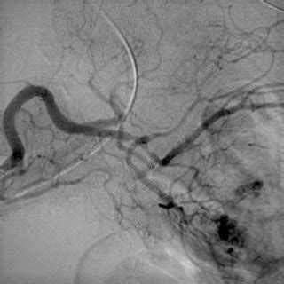 Image result for Angiogram with Embolization