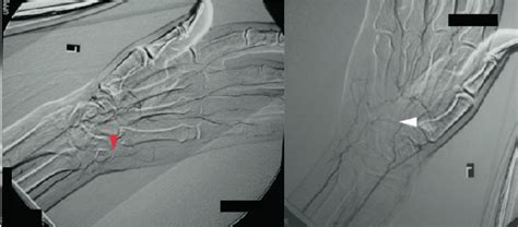 Image result for Hand Angiogram