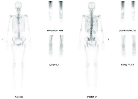 Image result for Triple Phase Bone Scan