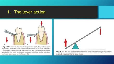 Image result for Principles of Tooth Extraction