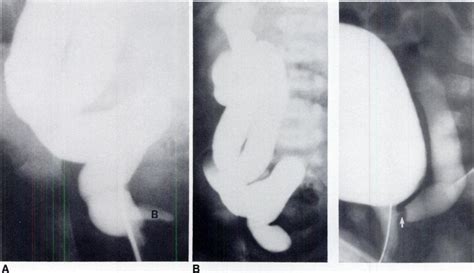 Image result for How Does a Voiding Cystourethrogram Test Work