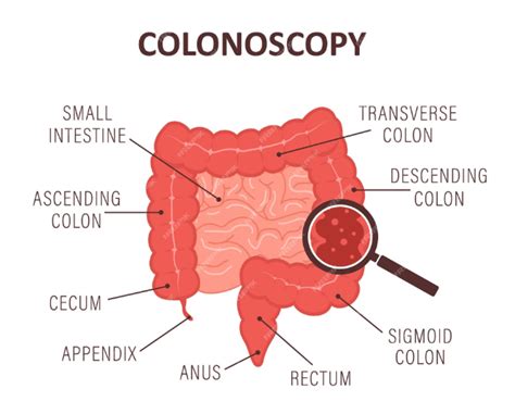 Image result for Normal Bowel Colonoscopy