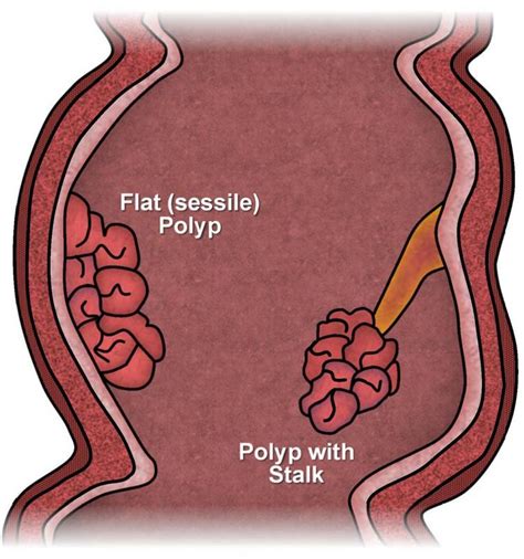 Image result for Colonoscopy Polyps Types