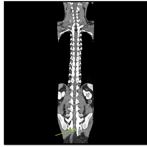 Image result for Spinal Angiogram