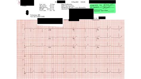Image result for Types of ST Depression