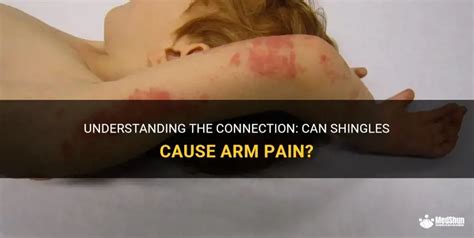 Image result for Shingles On Arm