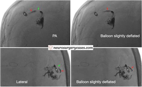 Image result for Embolization Procedure AVM