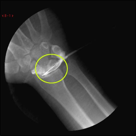 Image result for Wrist Arthrogram
