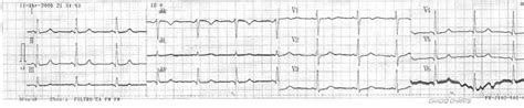 Image result for ECG 12 Derivaciones Normal