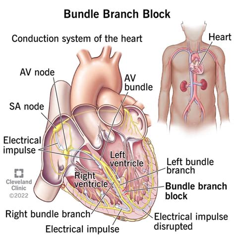 Image result for Incomplete Bundle Branch Block Left Treatment