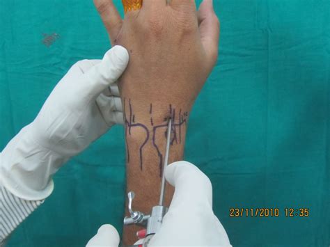 Image result for Wrist Arthrogram