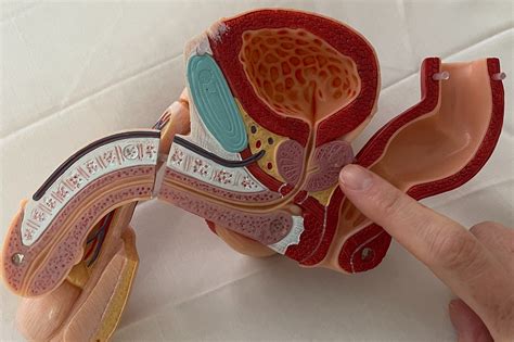 Image result for Exercise After Radical Prostatectomy