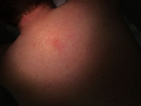 Image result for Upper-Back Cyst Surgery