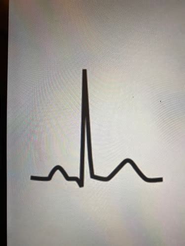 Image result for Types of ST Depression