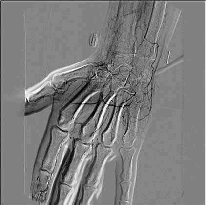 Image result for Hand Angiogram