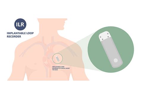 Image result for Loop Recorder Monitor