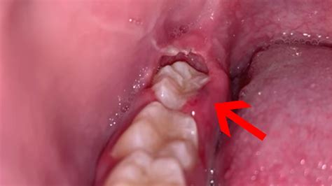 Image result for Wisdom Tooth Overlap