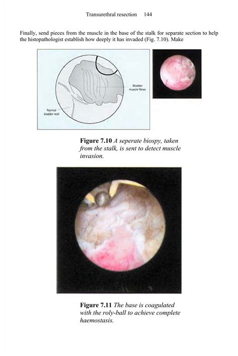 Image result for Transurethral Procedure
