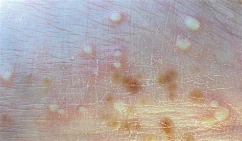 Image result for Types of Pustular Psoriasis