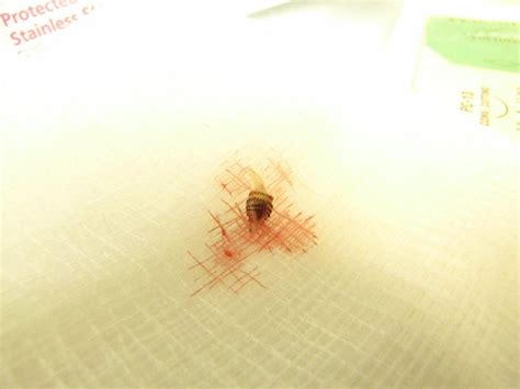 Image result for Bot Fly Larvae Removal