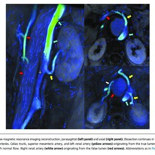 Image result for Type 2 Aortic Dissection