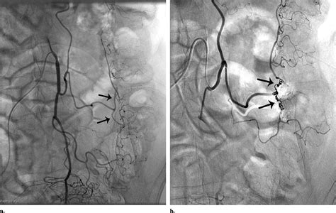 Image result for Angiogram with Embolization