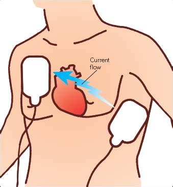 Defibrillation | Nurse Key