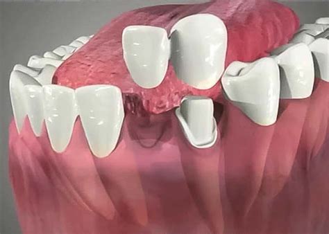 Image result for Denture Types