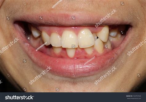 Image result for Wisdom Tooth Overlap