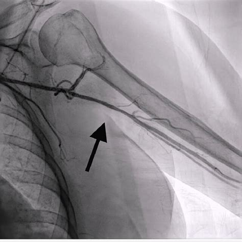 Image result for Left Lower Extremity Angiogram