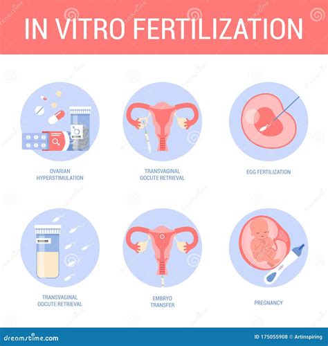 Image result for In Vitro Fertilization Procedure Step by Step