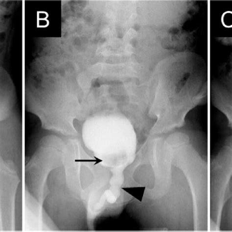 Image result for Voiding Cystourethrogram Image