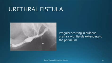 Image result for Acending Urethrogram