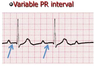 Image result for Paediatric PR Interval