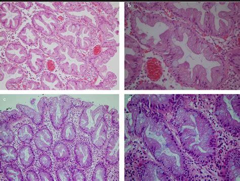 Image result for Colonoscopy Frequency Hyperpplastic Polyp