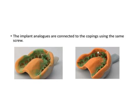 Image result for Impression Procedure