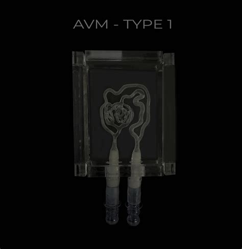 Image result for Embolization Procedure AVM