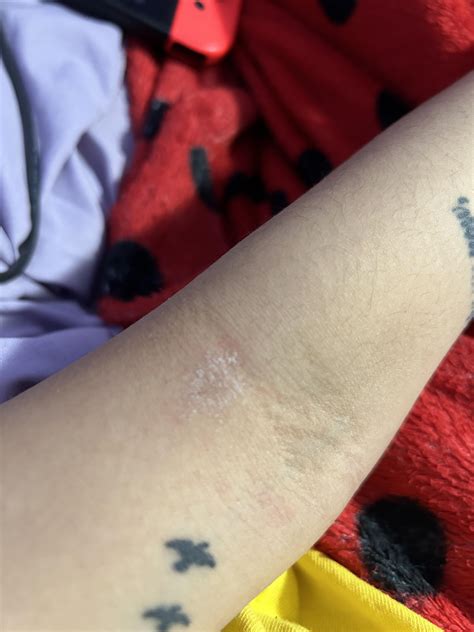 Image result for Scleroderma Skin