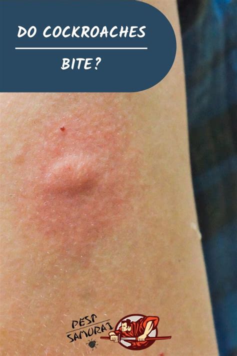 Image result for Cockroach Bites On Humans