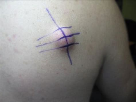 Image result for Upper-Back Cyst Surgery