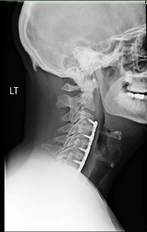 Image result for ACDF Surgery Is Serious