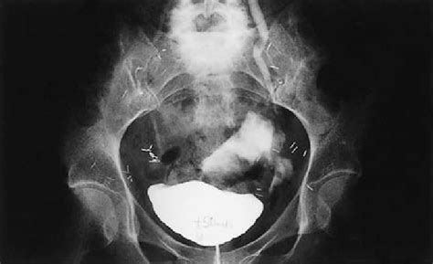 Image result for Urogram Triphasic