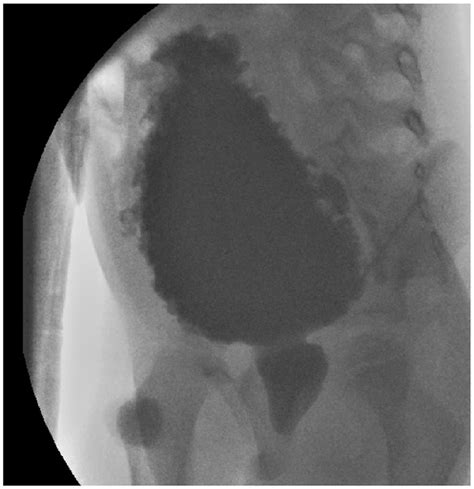 Image result for Cystourethrogram