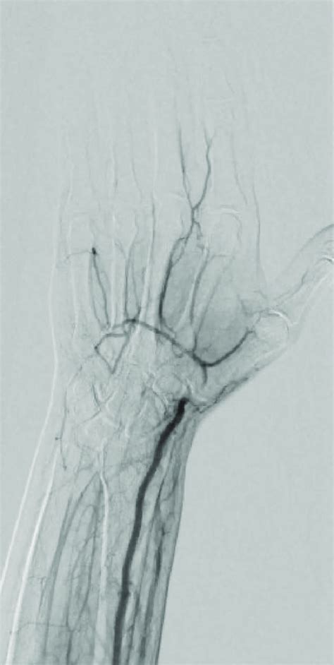 Image result for Angiogram Radial