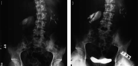 Image result for Urogram Triphasic