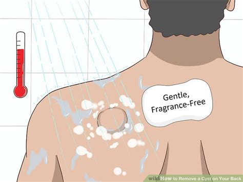 Image result for Upper-Back Cyst Surgery