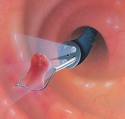 Image result for Colonoscopy Clips for Polyps