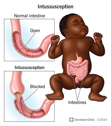 Image result for Intussusception in Arabic