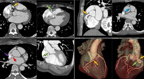 Image result for Normal Coronary CT Angiogram